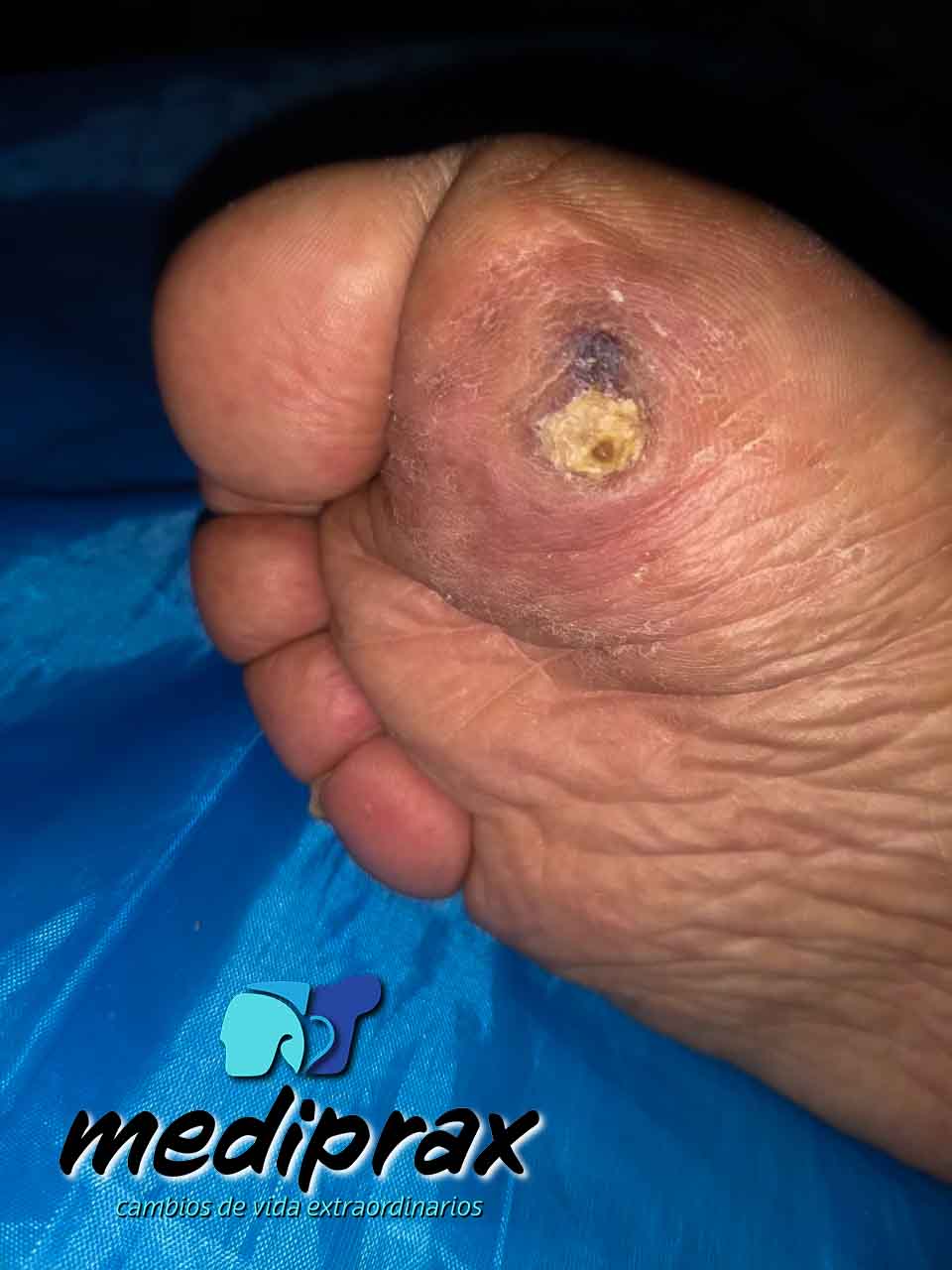 Amputación de pie diabético y sus cuidados - Mediprax